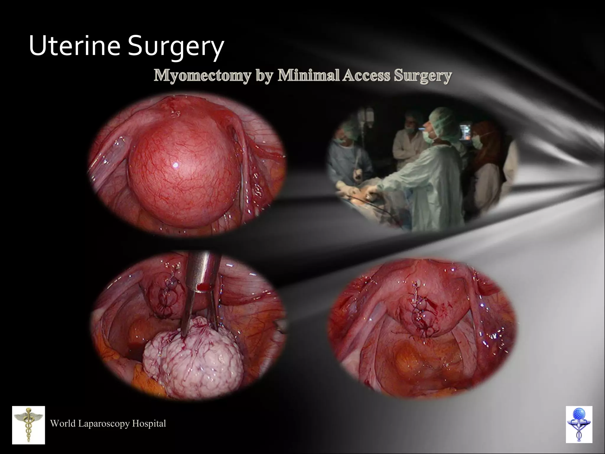 Introduction of Laparoscopic Surgery | PPT