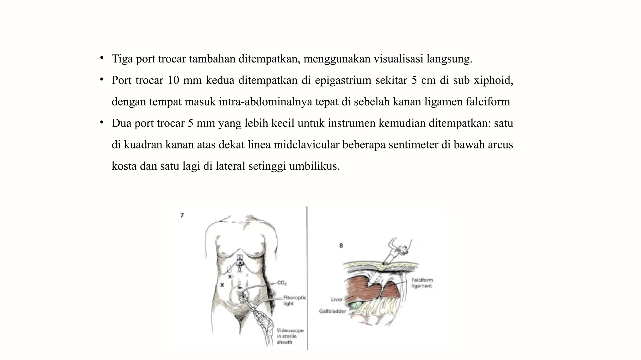 Laparoscopy cholesistektomi OPTEKKKK PPT | PPTX