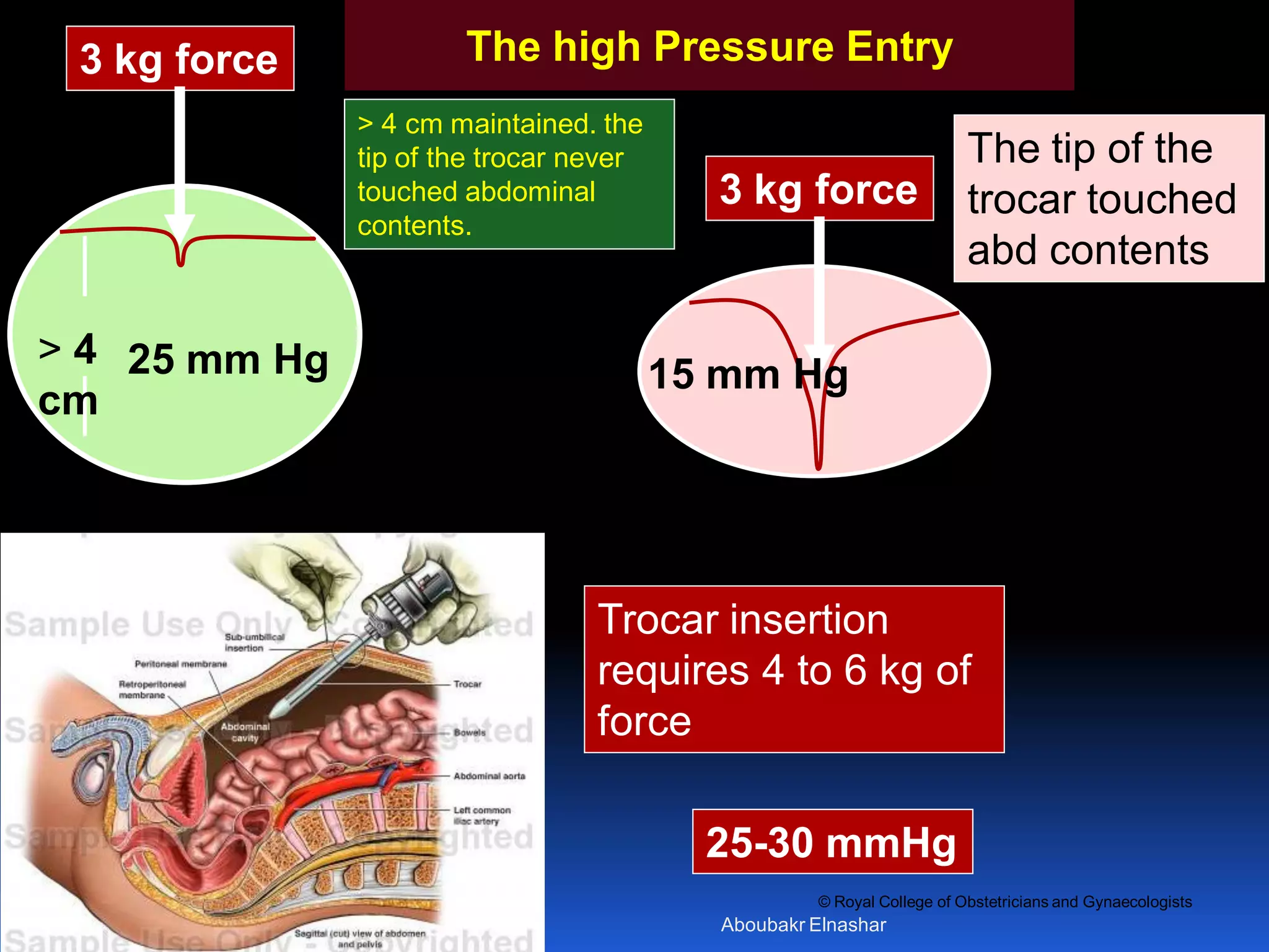 LAPAROSCOPIC ENTRY | PDF
