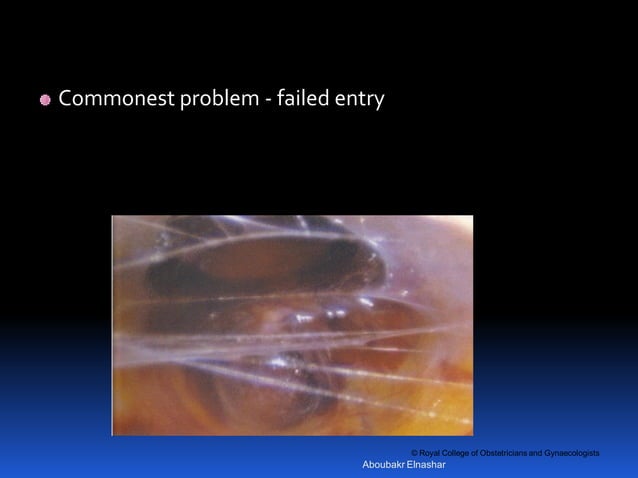 LAPAROSCOPIC ENTRY | PDF