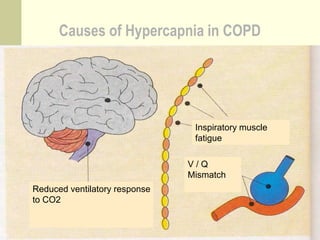 Laparoscopy in COPD: Anaesthesia | PPTX