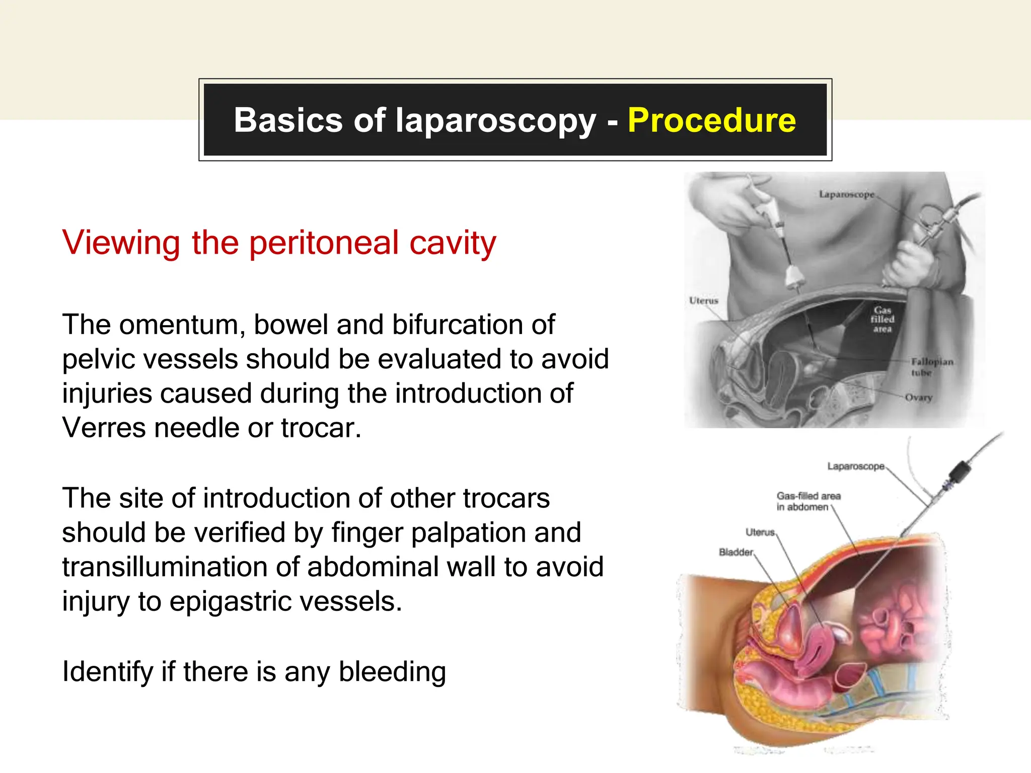 laparoscopy in gynaecology nursing students | PPTX