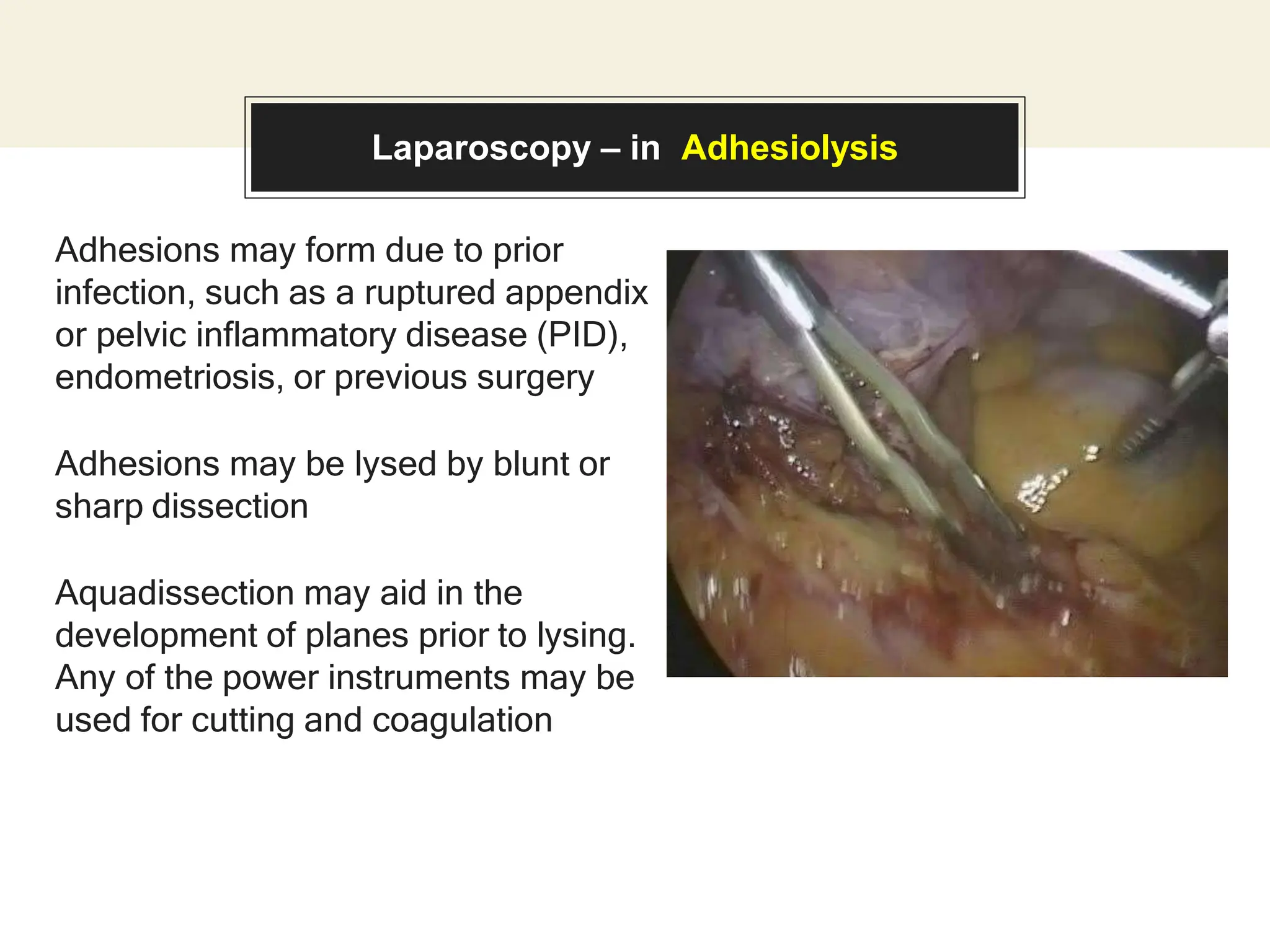 laparoscopy in gynaecology nursing students | PPTX