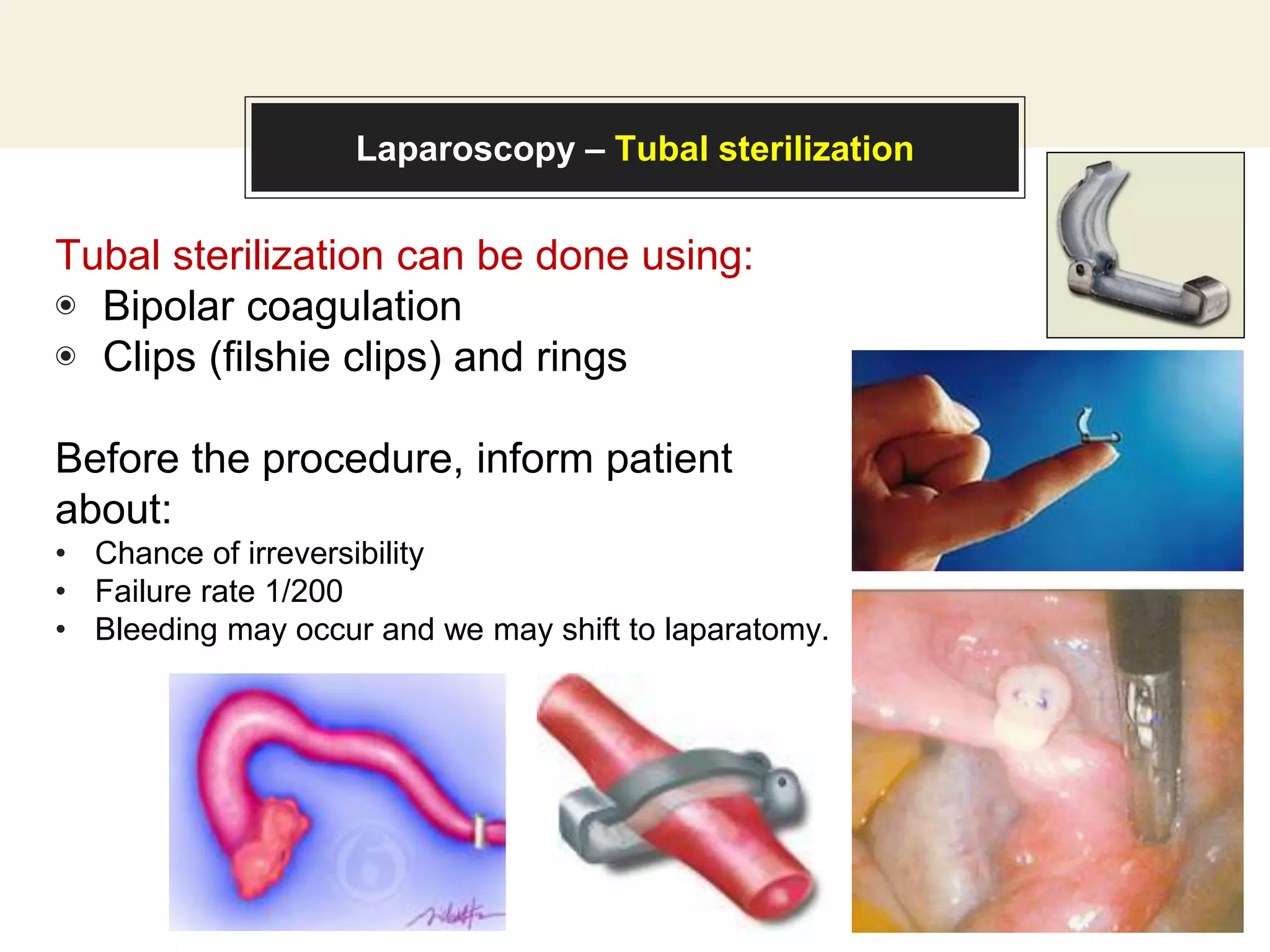 Laparoscopy in gynecology | PDF