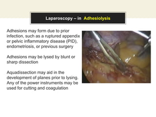 Laparoscopy in gynecology | PDF