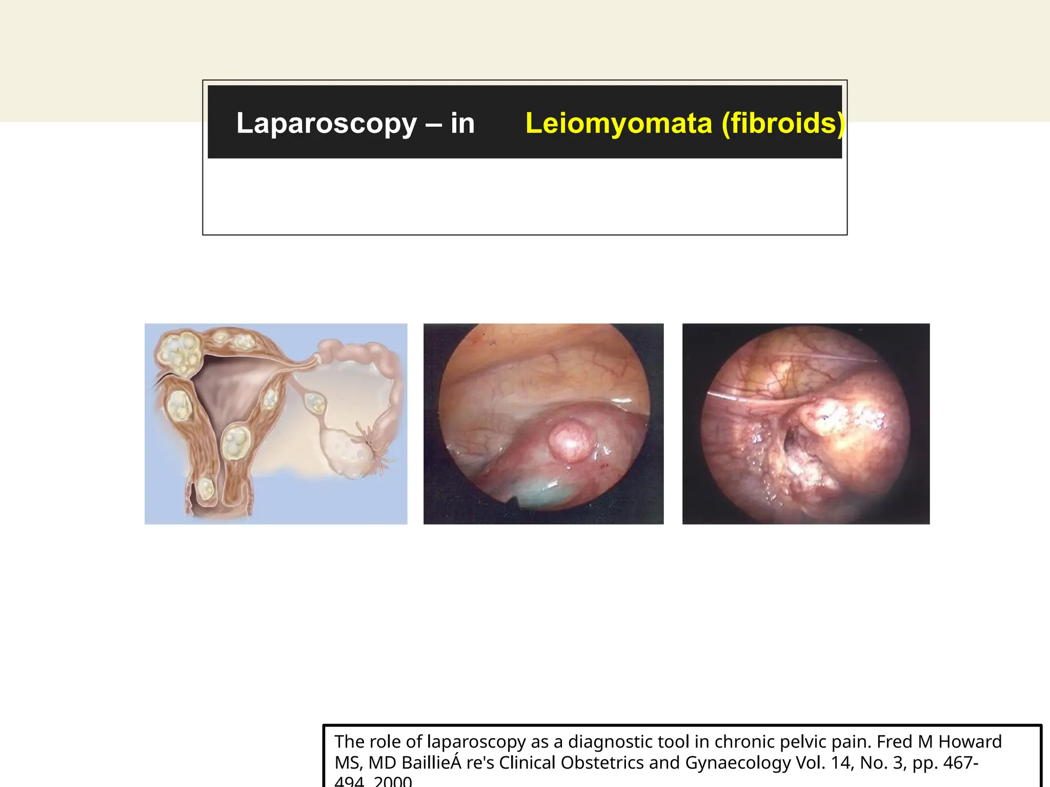 laparoscopyingynecology-180309070515 (1).pptx