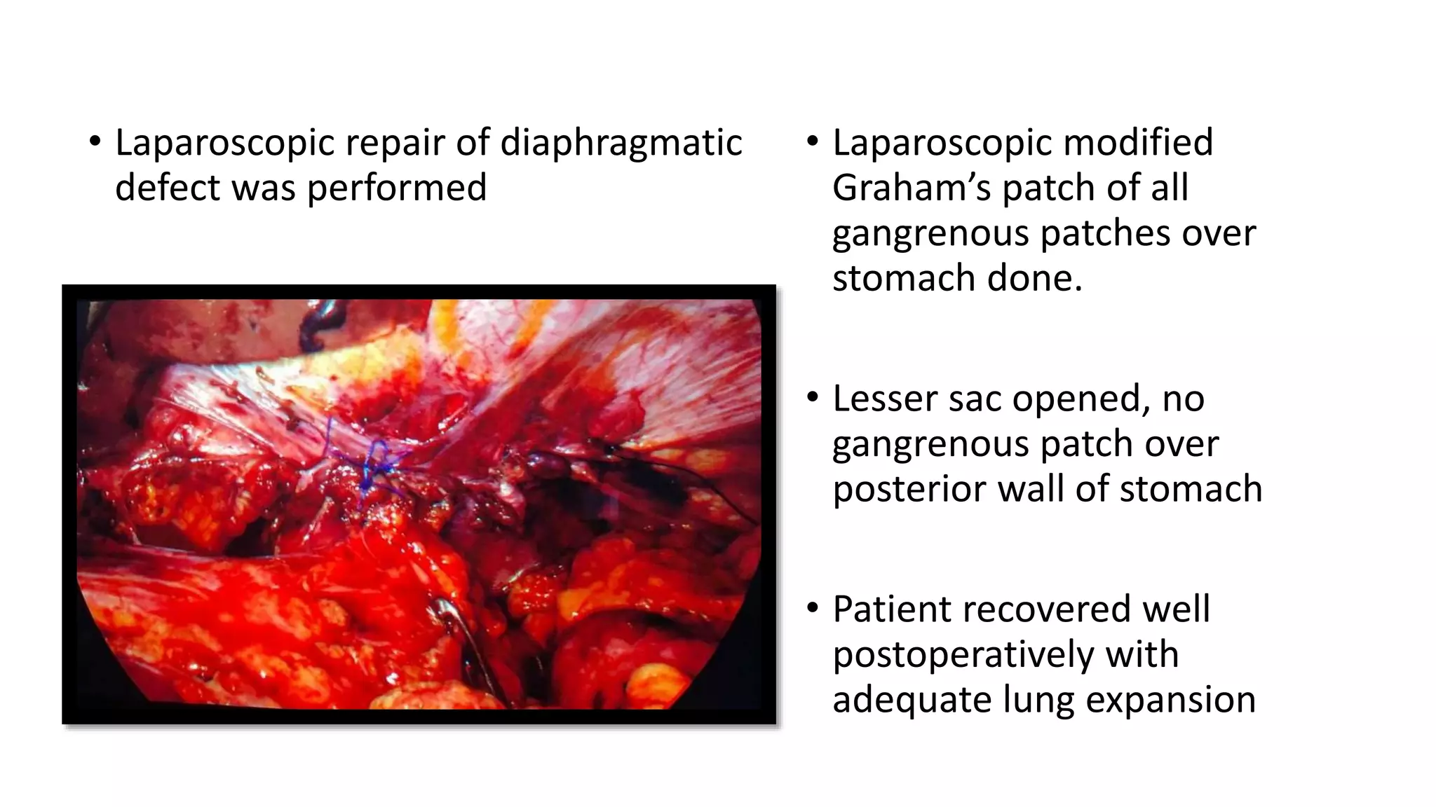 Laparoscopy in trauma | PPTX