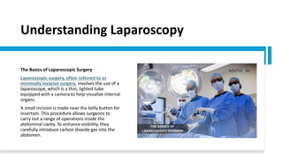 Laparoscopy Surgery - Benefits & Recovery Process.pdf