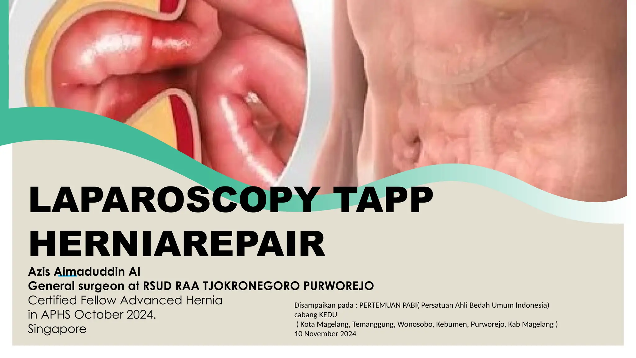 LAPAROSCOPY TAPP HERNIA inguinal ( tehnik operasi ) azis | PPTX