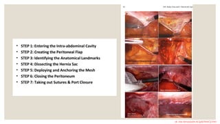 LAPAROSCOPY TAPP HERNIA inguinal ( tehnik operasi ) azis | PPTX