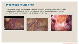 LAPAROSCOPY TAPP HERNIA inguinal ( tehnik operasi ) azis | PPTX