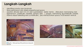 LAPAROSCOPY TAPP HERNIA inguinal ( tehnik operasi ) azis | PPTX
