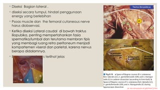 LAPAROSCOPY TAPP HERNIA inguinal ( tehnik operasi ) azis | PPTX