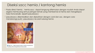 LAPAROSCOPY TAPP HERNIA inguinal ( tehnik operasi ) azis | PPTX