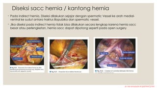 LAPAROSCOPY TAPP HERNIA inguinal ( tehnik operasi ) azis | PPTX