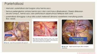 LAPAROSCOPY TAPP HERNIA inguinal ( tehnik operasi ) azis | PPTX