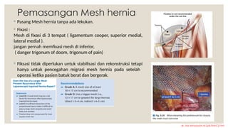 LAPAROSCOPY TAPP HERNIA inguinal ( tehnik operasi ) azis | PPTX
