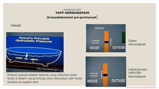LAPAROSCOPY TAPP HERNIA inguinal ( tehnik operasi ) azis | PPTX