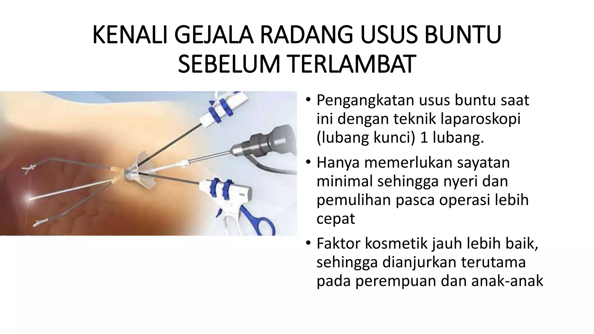 Laparoskopi Appendectomy Single Hole omni.pptx