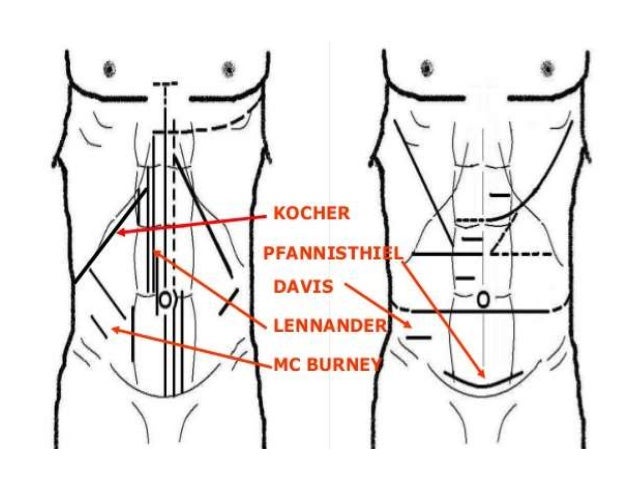 Laparotomia e fechamento