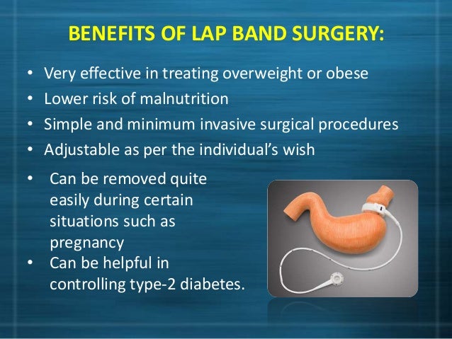 Lap band surgery in Los Angeles-All about Lap band Surgery