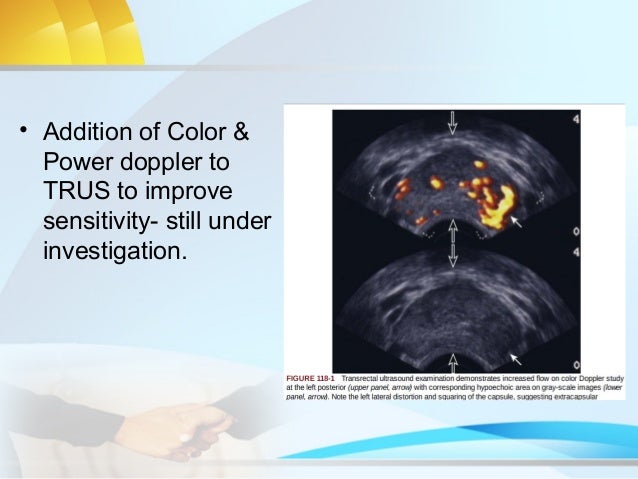 Locally Advanced Prostate Cancer
