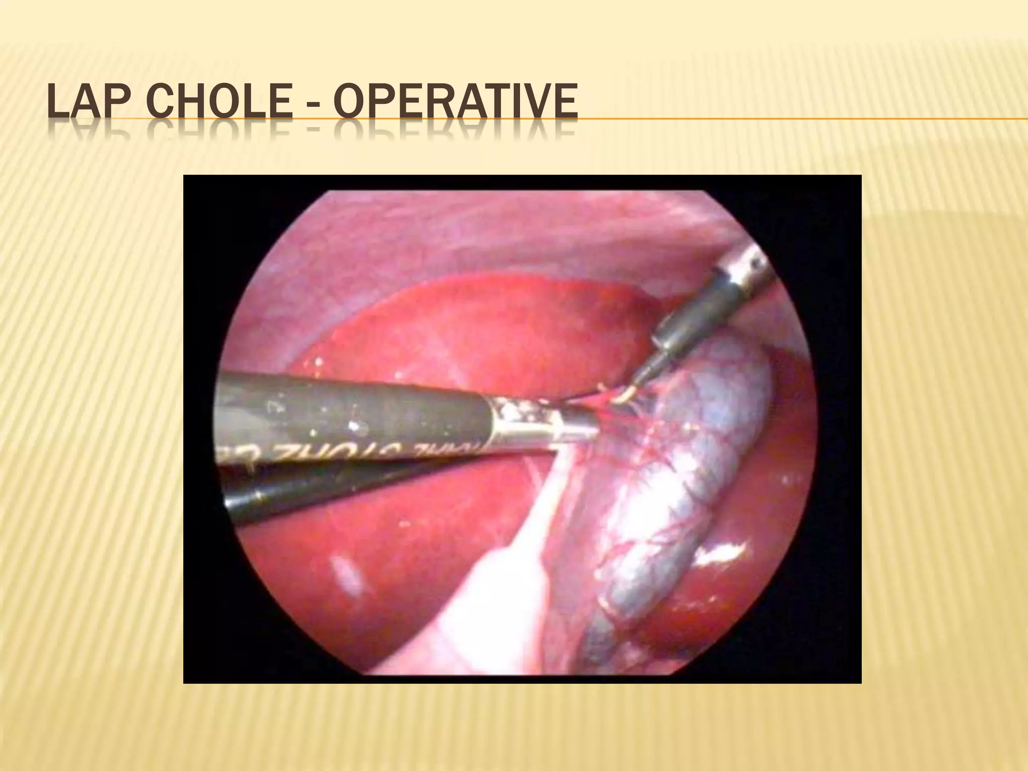 Day Care Lap Chole in Children | PPTX