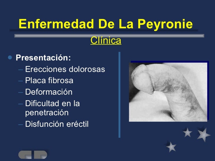 La peyronie