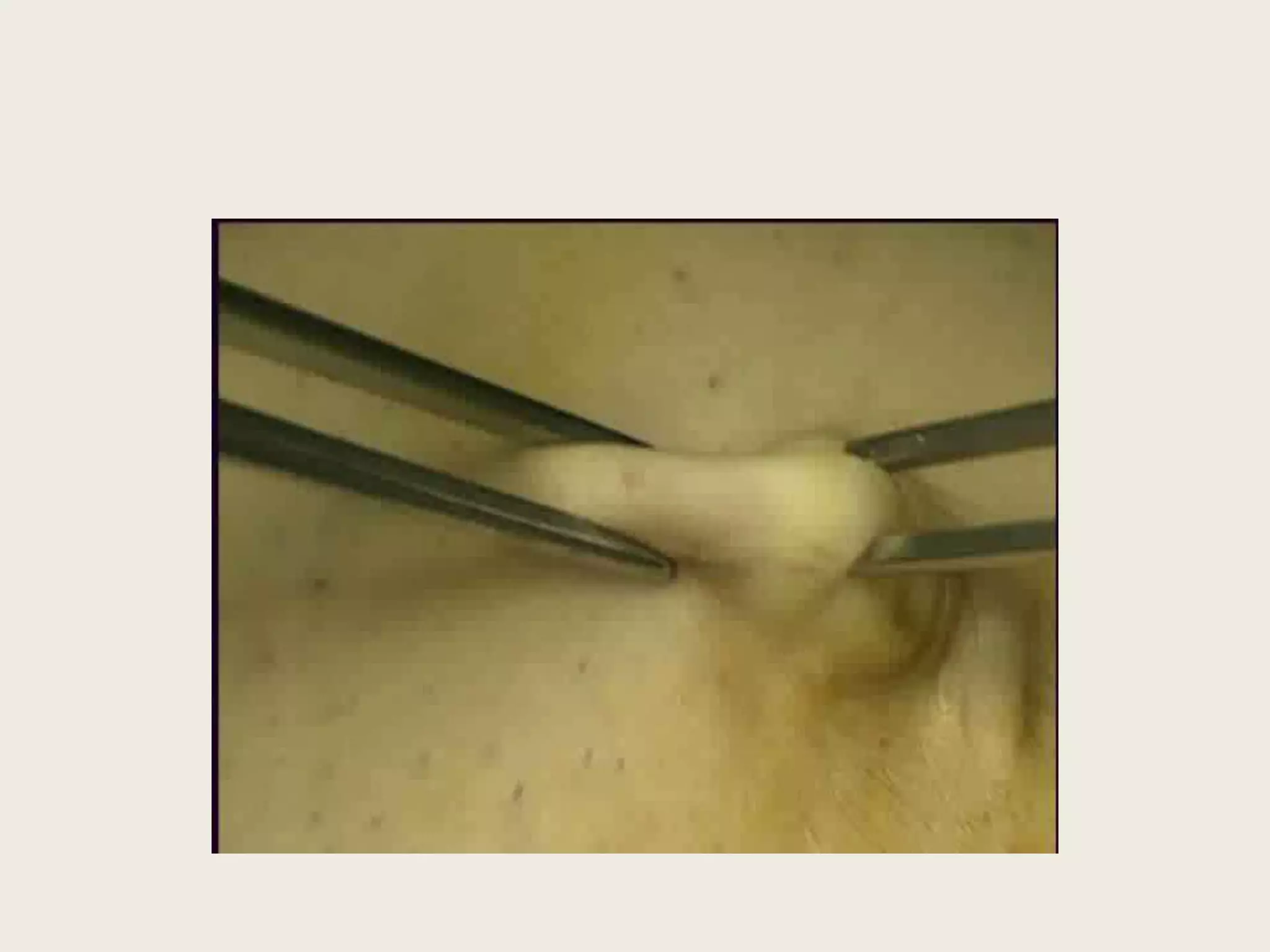 Laparoscopic inguinal hernia repair (TAPP) | PPTX