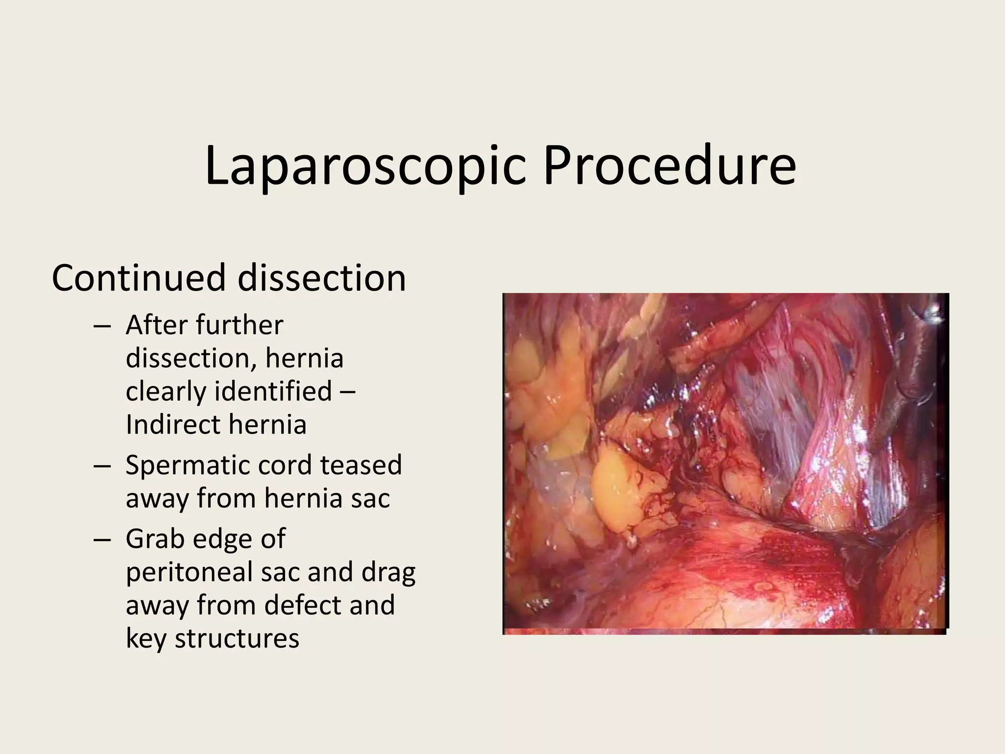 Laparoscopic inguinal hernia repair (TAPP) | PPTX