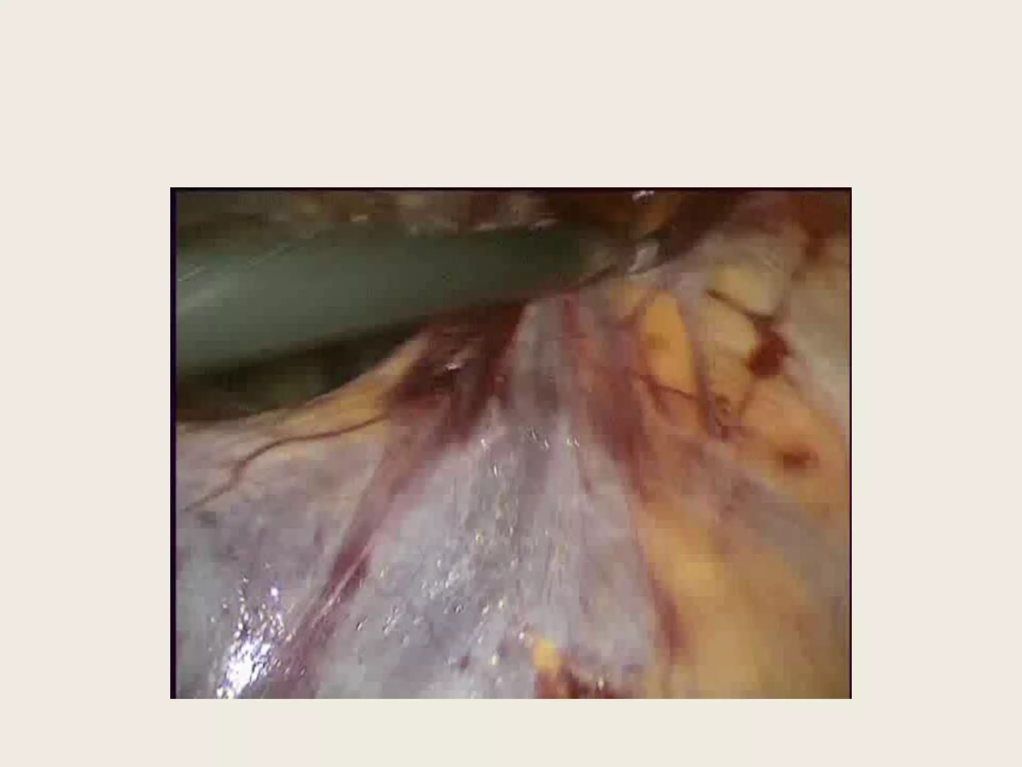 Laparoscopic inguinal hernia repair (TAPP) | PPTX