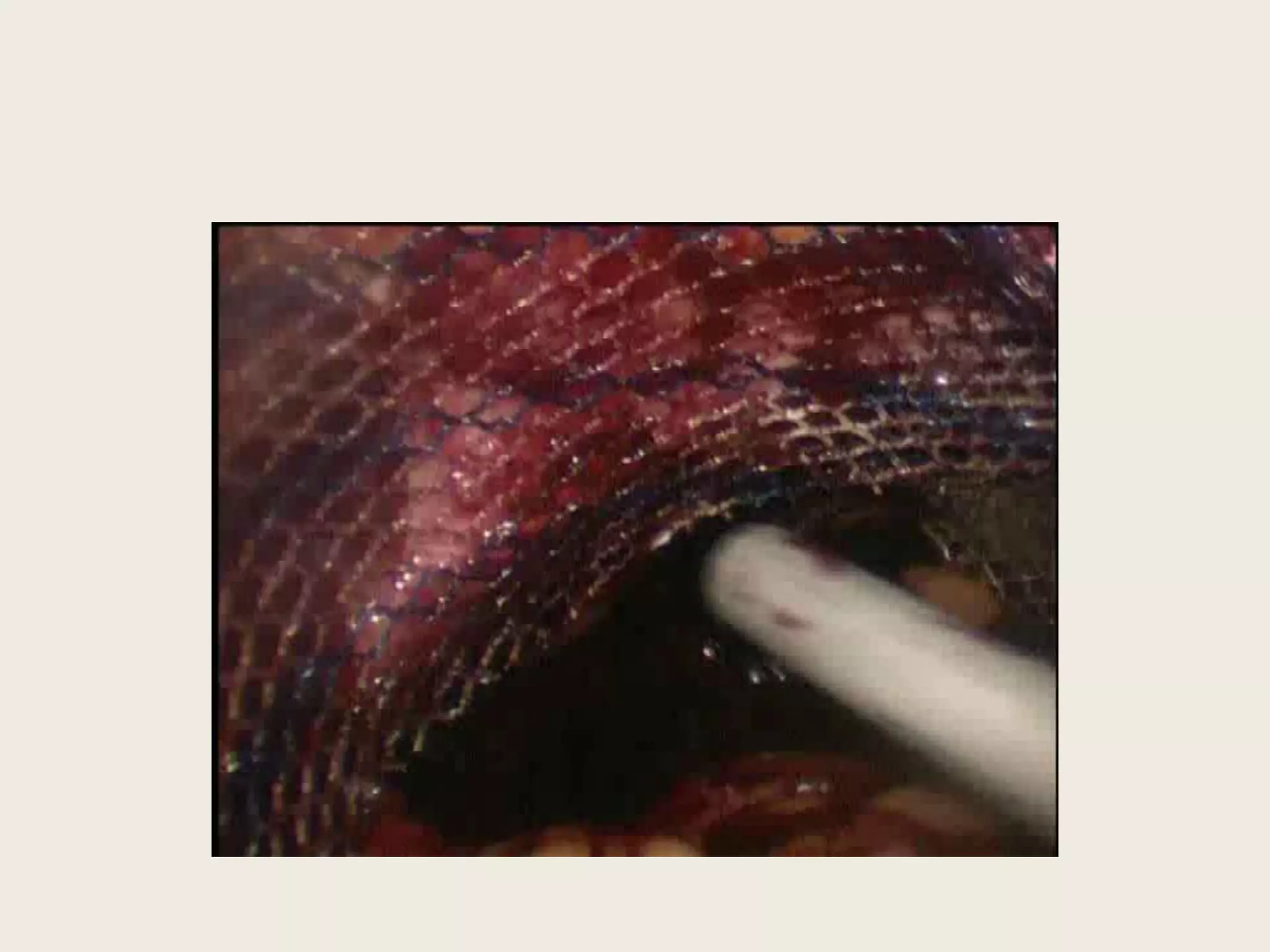 Laparoscopic inguinal hernia repair (TAPP) | PPTX