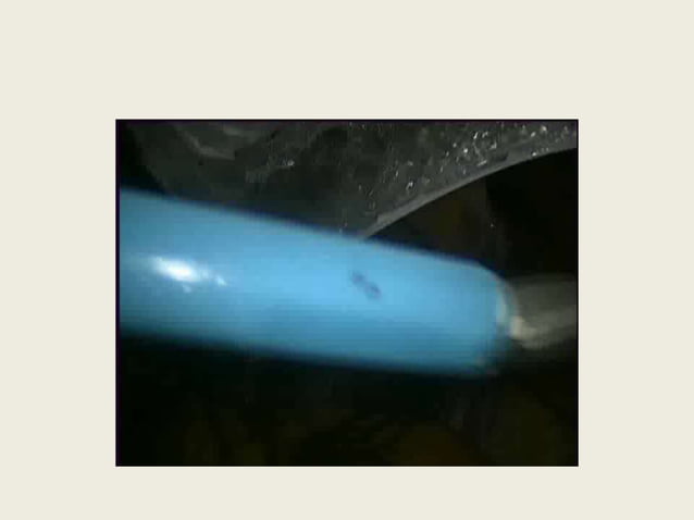 Laparoscopic inguinal hernia repair (TAPP) | PPTX