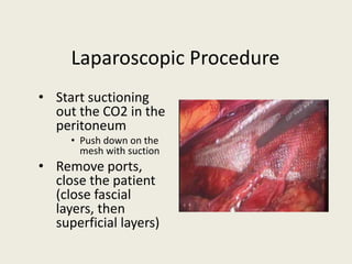 Laparoscopic inguinal hernia repair (TAPP)