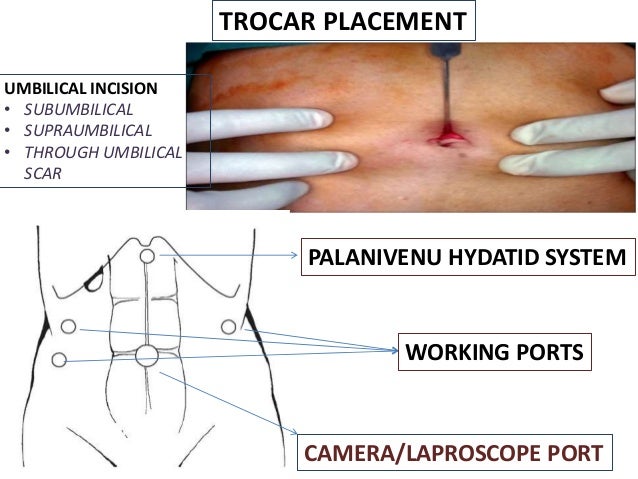 Laproscopic Hydatid Cyst