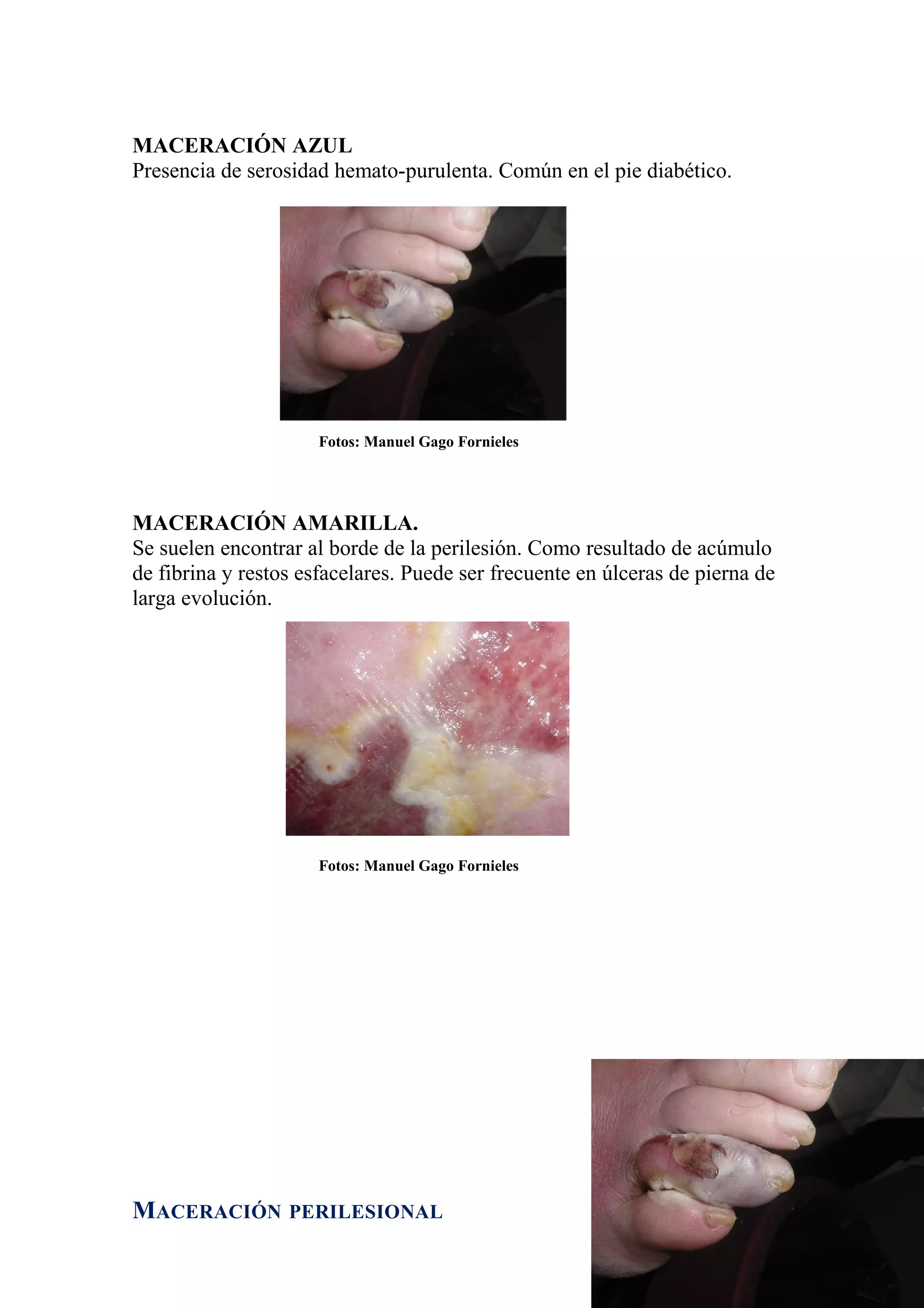 La piel perilesional esa gran olvidada. | DOC | First Aid | Injuries