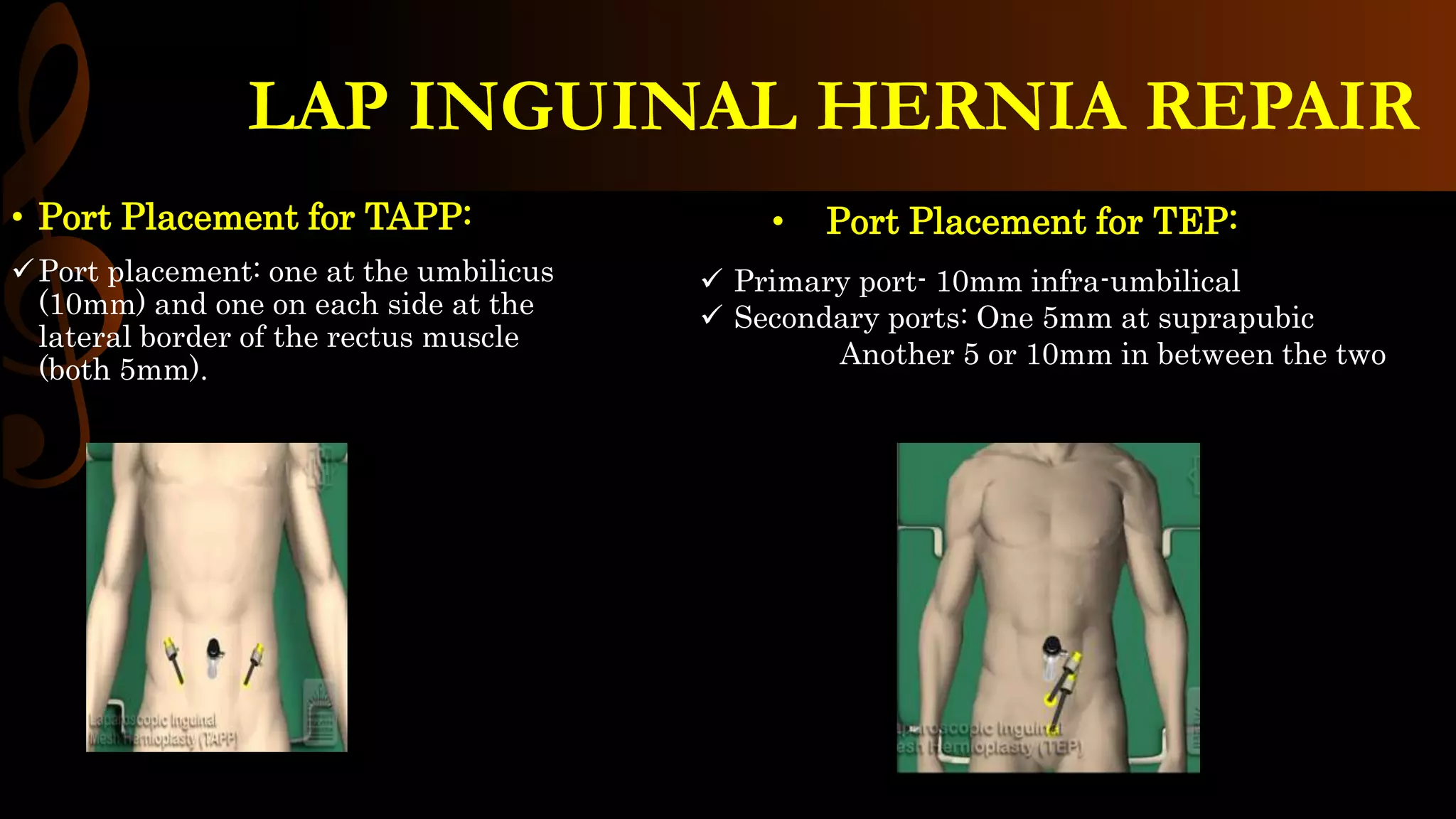 Lap inguinal hernia repair/ operative surgery | PPTX