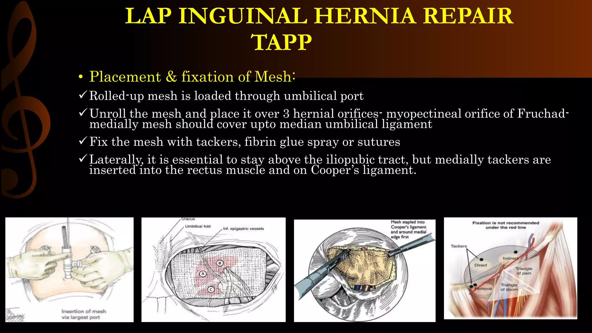 Lap inguinal hernia repair/ operative surgery | PPTX