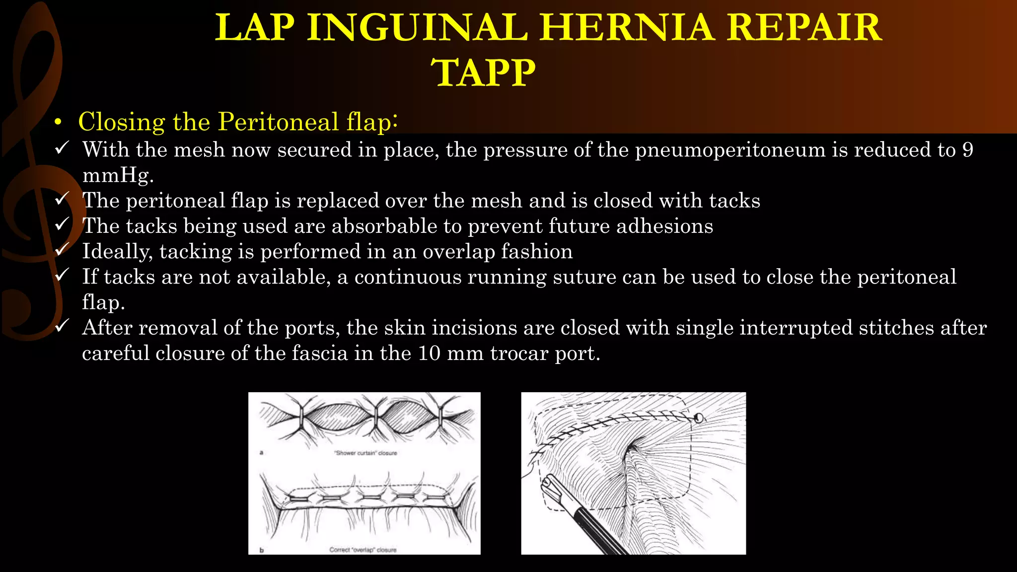 Lap inguinal hernia repair/ operative surgery | PPTX