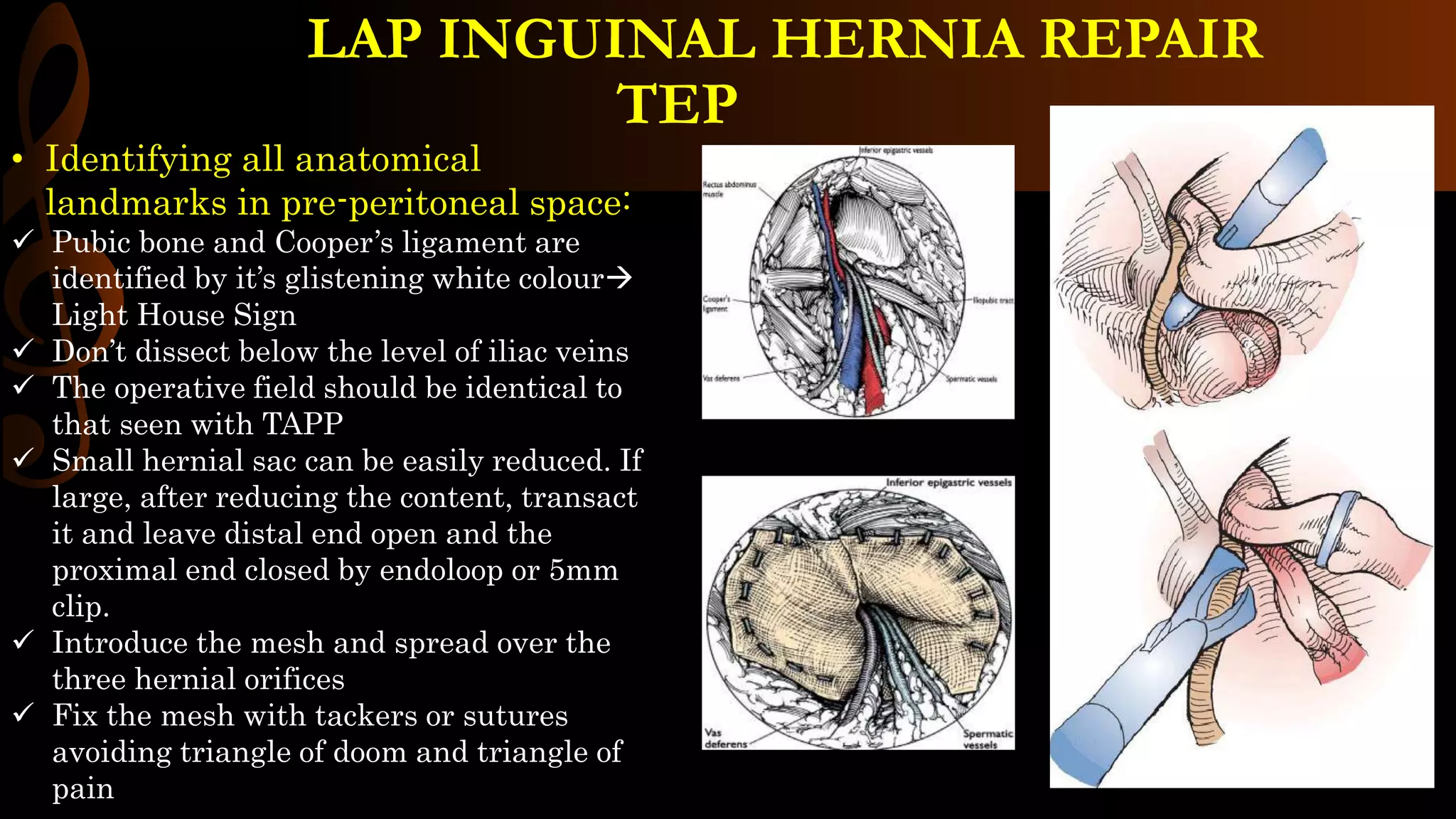 Lap inguinal hernia repair/ operative surgery | PPTX