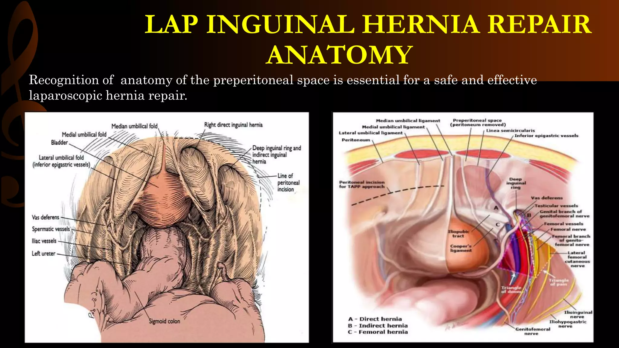 Anatomia Da Hernia Inguinal Laparoscopica