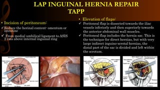 Lap inguinal hernia repair/ operative surgery | PPTX