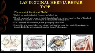 Lap inguinal hernia repair/ operative surgery | PPTX