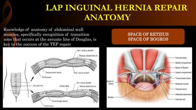 Lap inguinal hernia repair/ operative surgery | PPTX