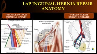 Laparoscopic Inguinal Hernia Repair Triangle Of Doom