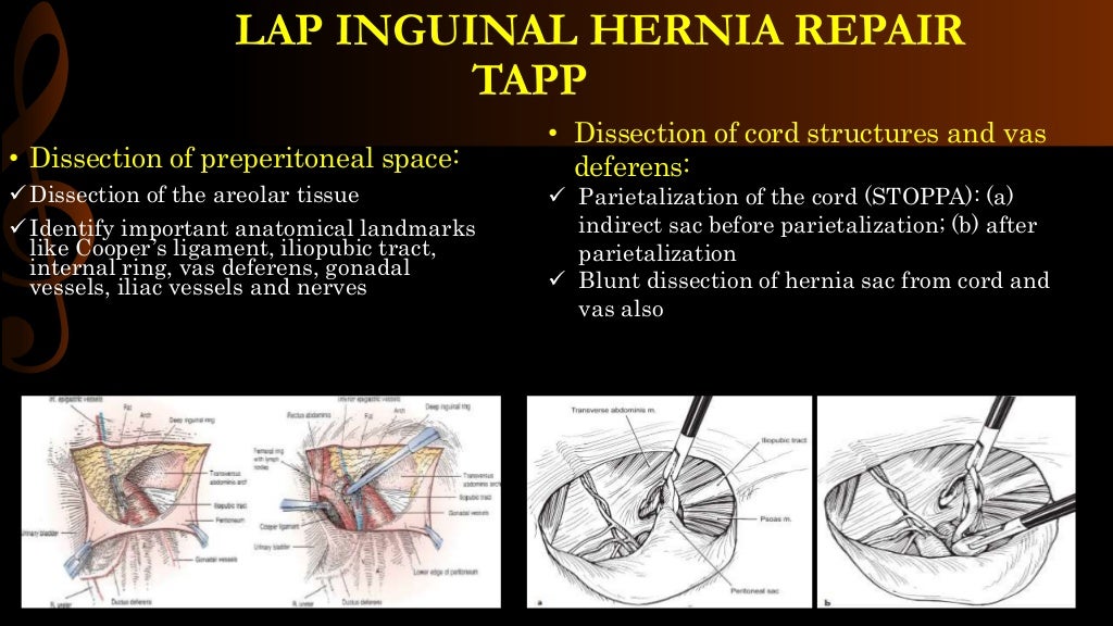 Lap inguinal hernia repair/ operative surgery