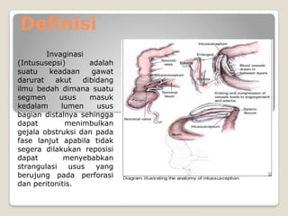 laporan kasus gambaran radiologi pada kasus invaginasi.pptx