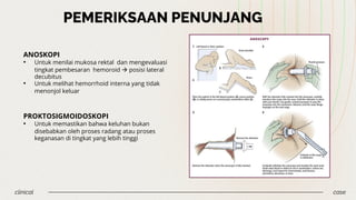 LAPKAS HEMOROID.pdf