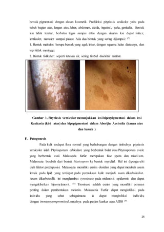 tine versikolor | DOCX