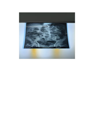 Lapkas Ulkus Gaster-dr.Teguh Rinjaya.pdf